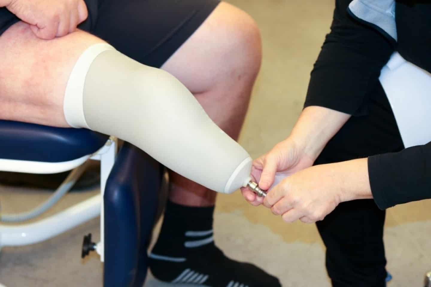 Emil fik benet knust i en transportvogn: 40 benproteser senere har han ...