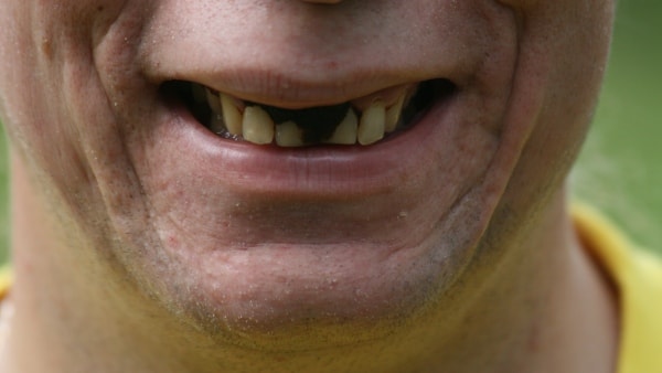 Chokerede tandlæger: Flere og flere unge kommer med snus-skader på ...