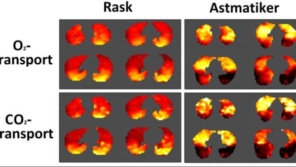 Ser ind i lungerne med ny metode | ugeavisen.dk